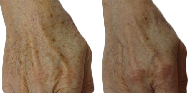 PRP / vampire lift – dermatosierre